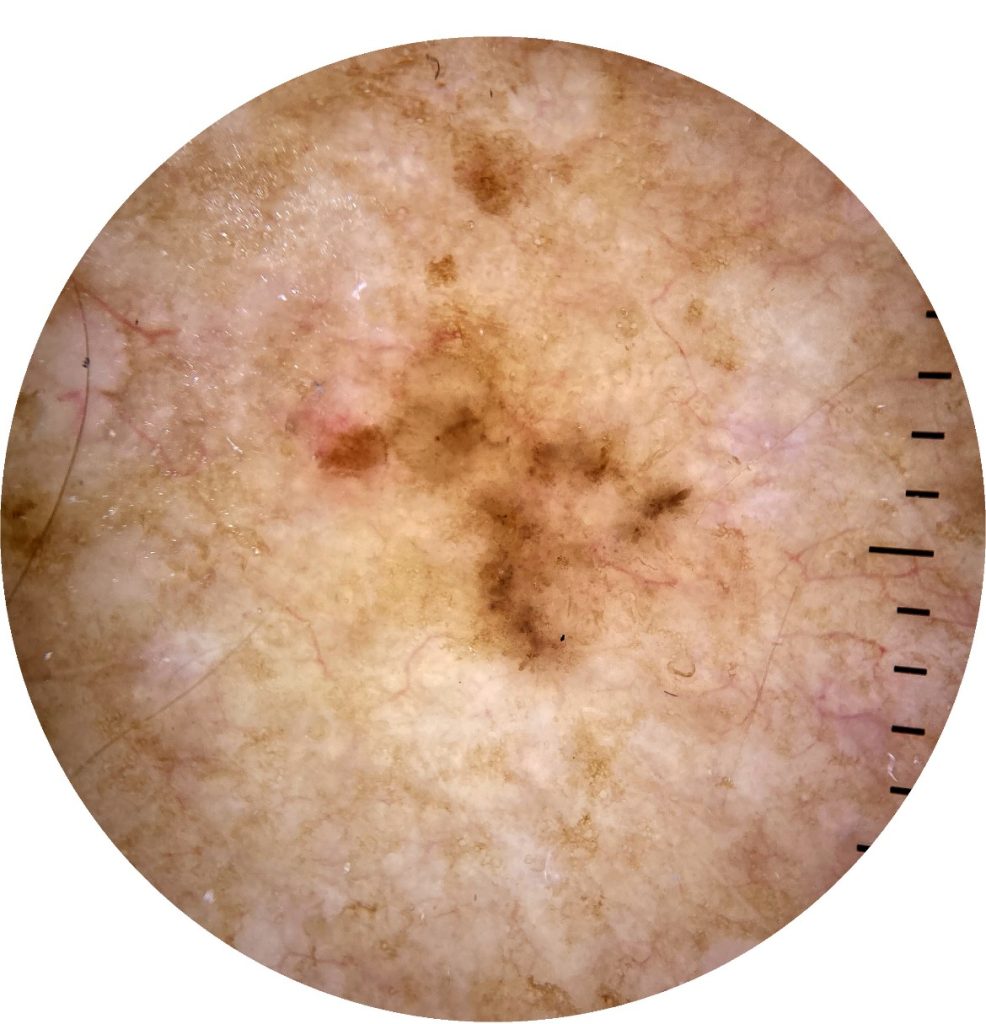 Basal cellcarcinoma - Skin Cancer Clinic Claremont