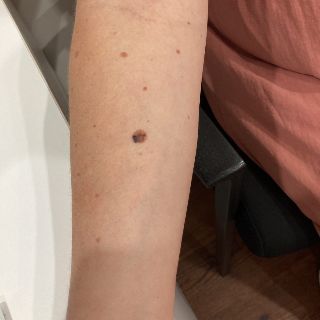 Melanoma Clinic Claremont - Skin Cancer Clinic Claremont